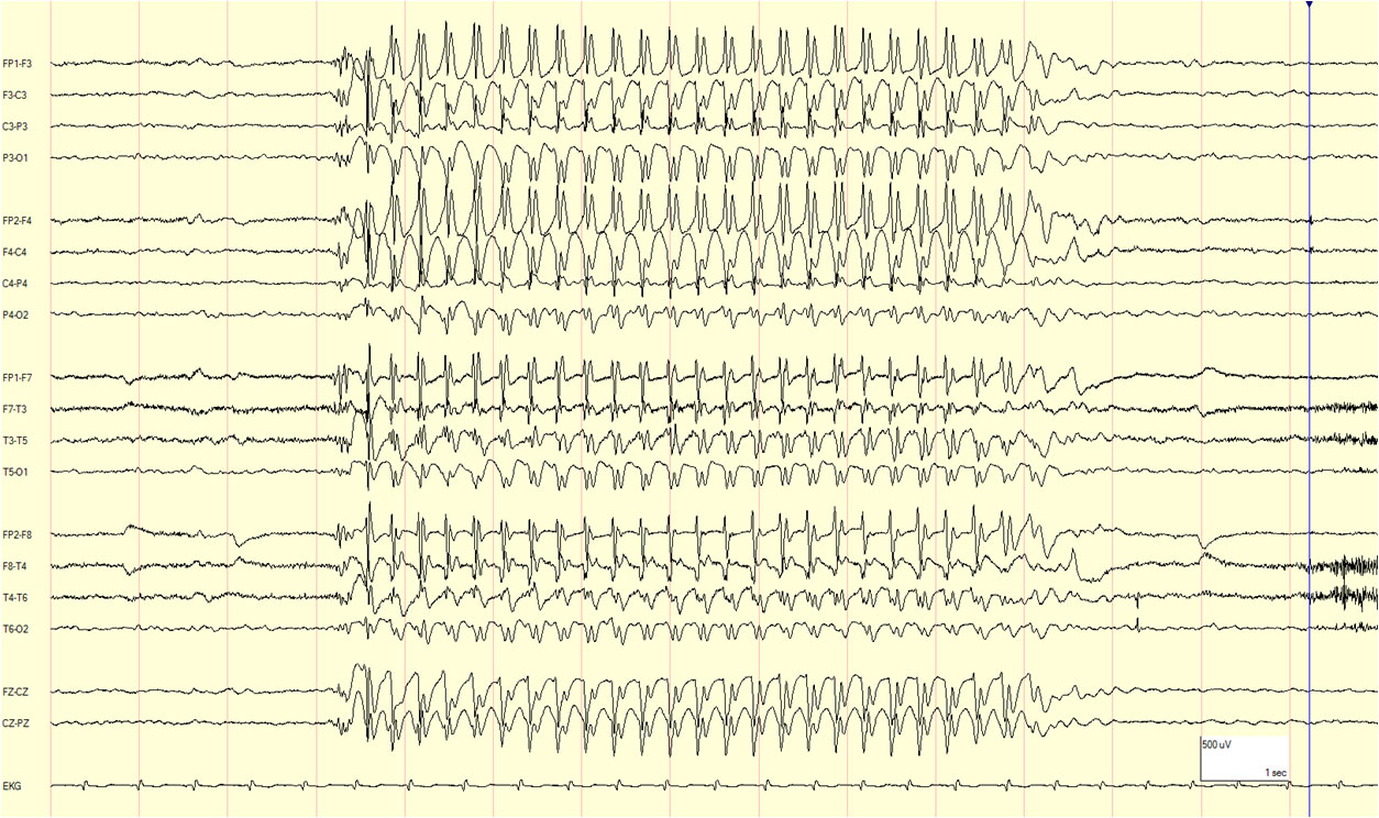 CHILDHOOD ABSENCE EPILEPSY CAE 